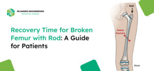 Recovery Time for Broken Femur with Rod: A Guide for Patients - Dr ...
